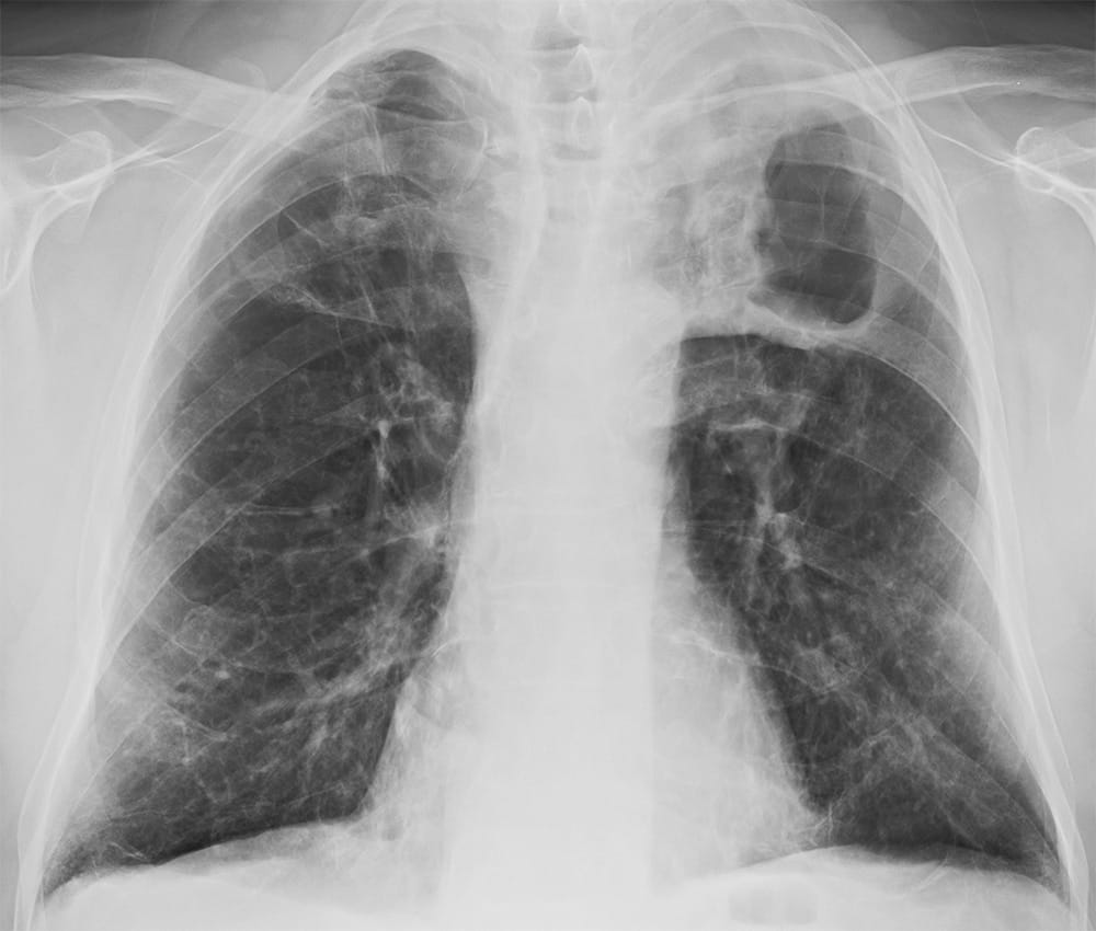 What is tuberculosis?