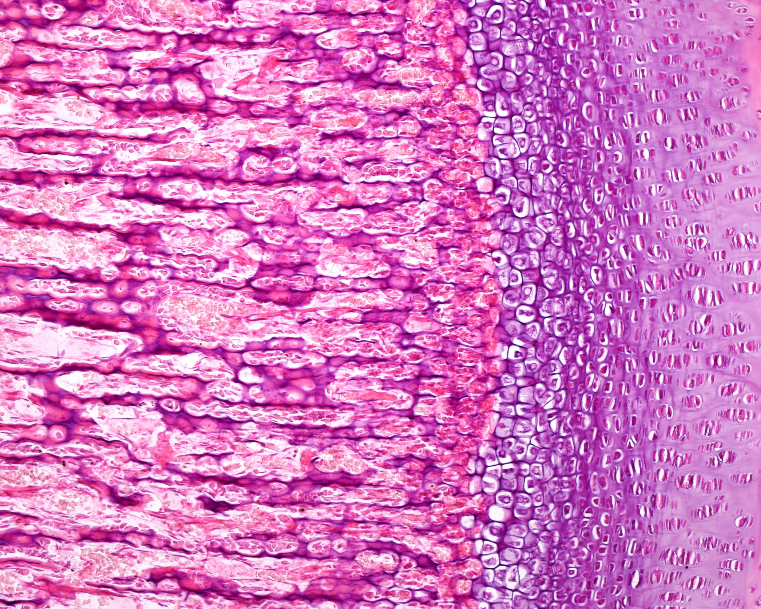 Achondroplasia Egenskaper Achondroplasia Clinical Presentation