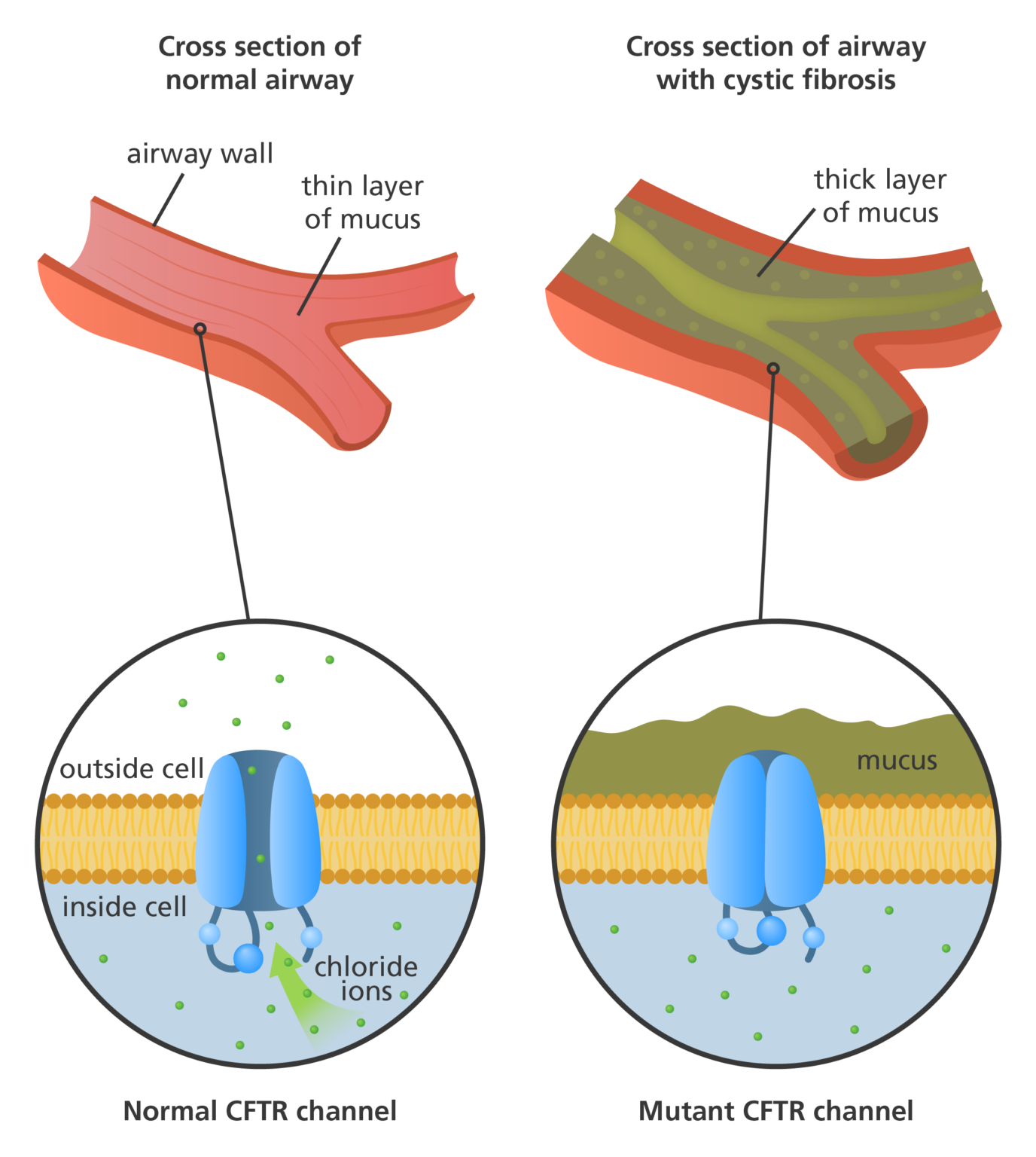 What is cystic fibrosis?