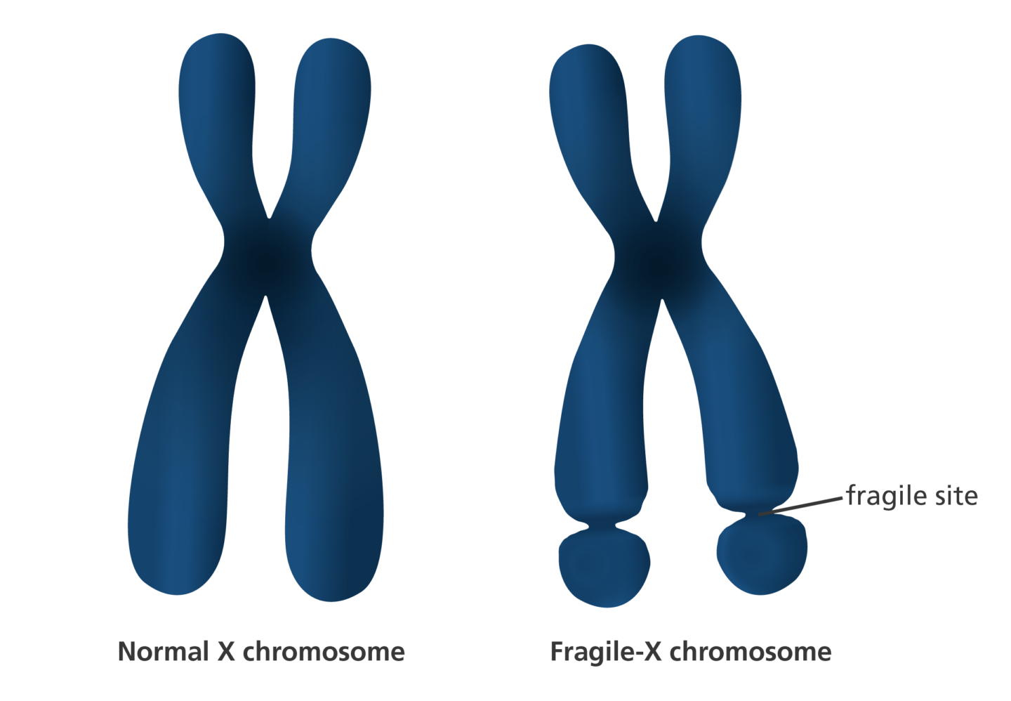 What is Fragile-X syndrome?