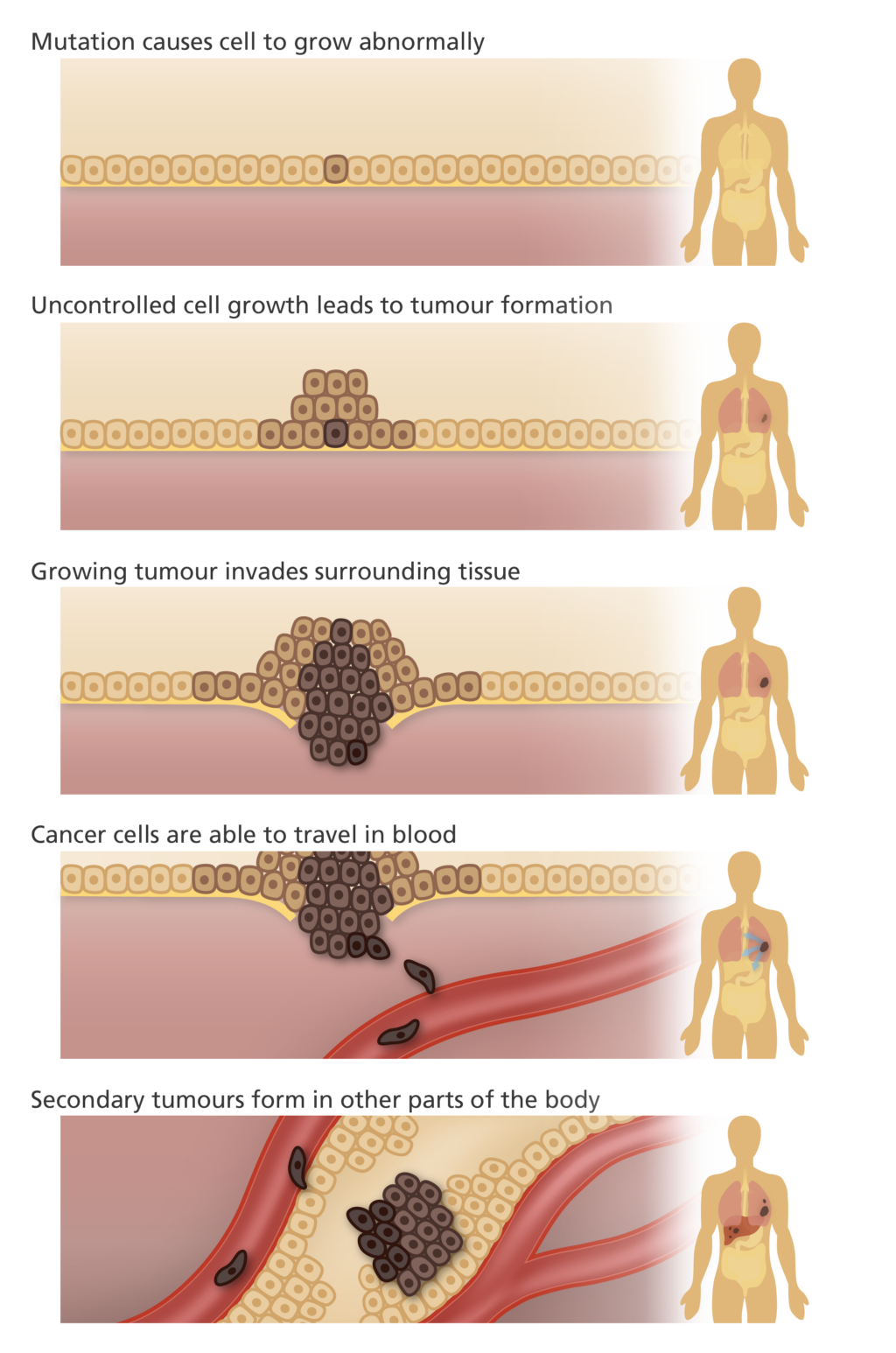 Is cancer a genetic disease?